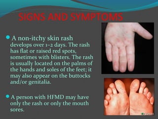 Hand Foot and Mouth Disease (HFMD) - RIS Clinic | PPT