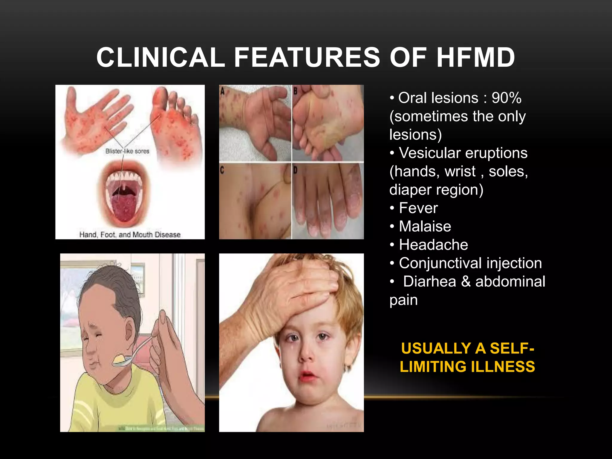 Hand foot-mouth disease (hfmd) | PDF