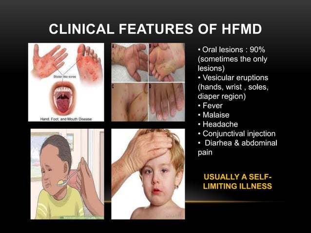 Hand foot-mouth disease (hfmd) | PPT