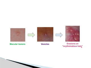 Hand -Foot and Mouth Disease PPT[8380].pptx