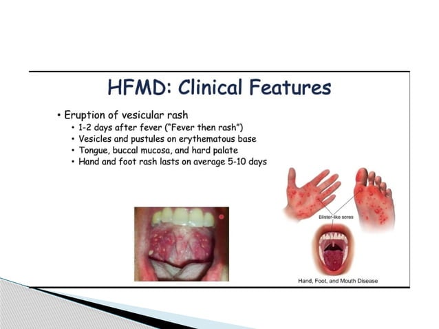 Hand -Foot and Mouth Disease PPT[8380].pptx