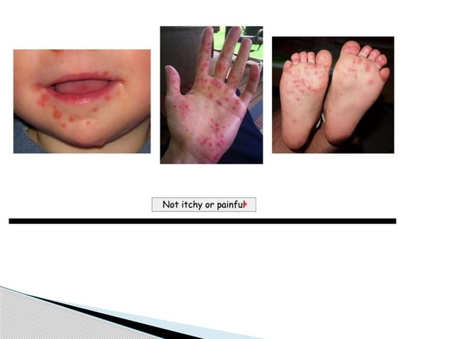 Hand -Foot and Mouth Disease PPT[8380].pptx