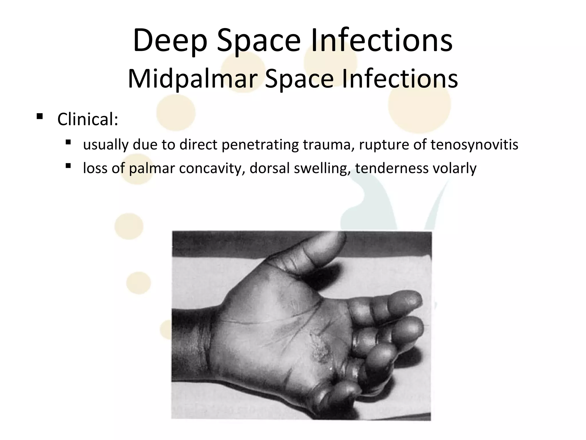 Hand infections | PPT