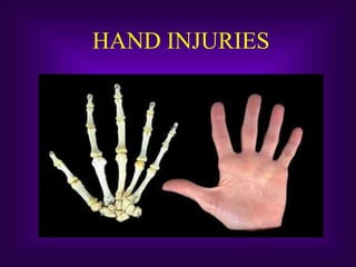 Hand injuries | PPSX