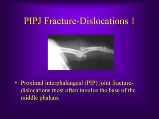 Hand injuries | PPSX