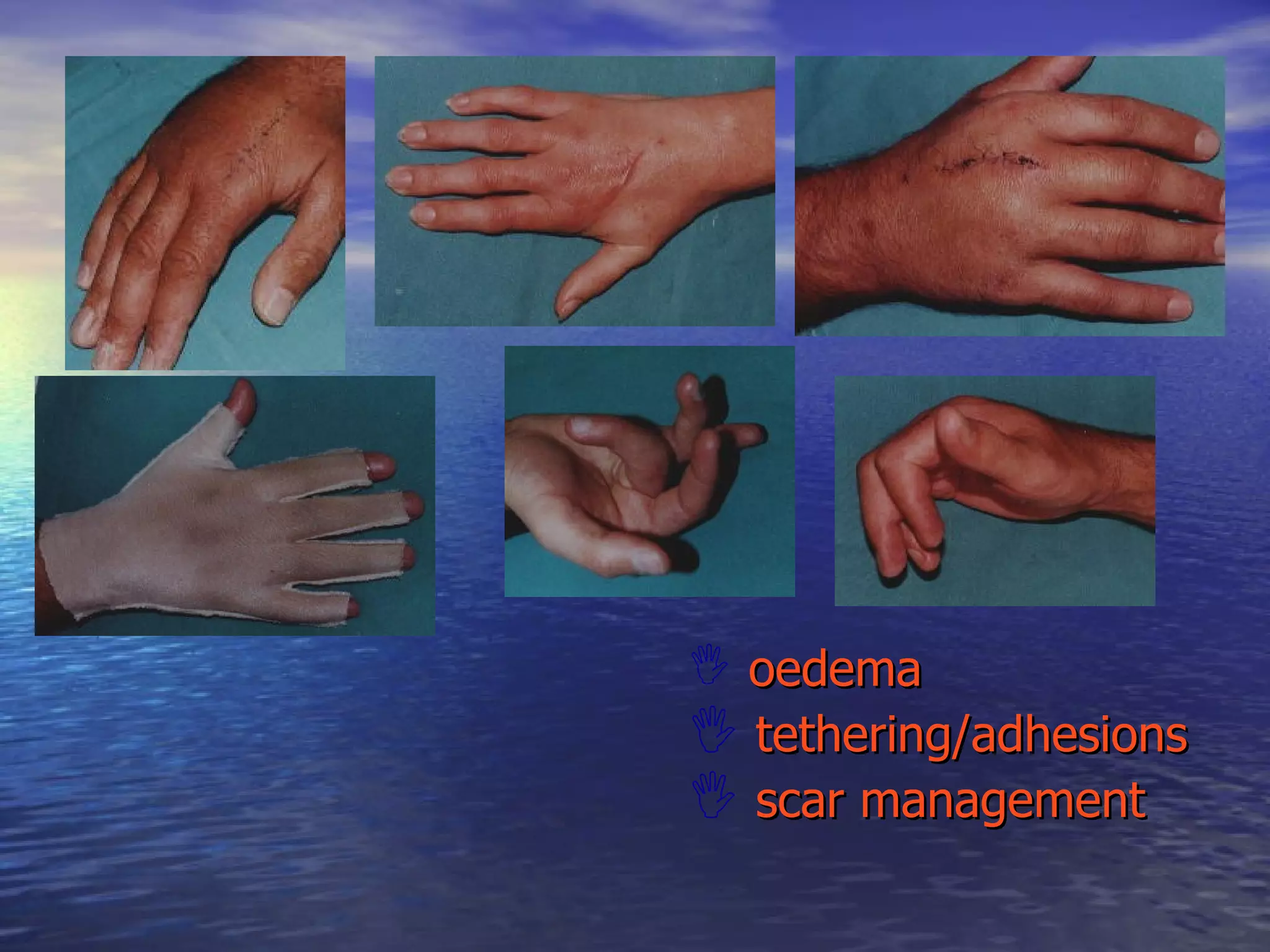 Hand Therapy Rehabilitation – Extensor Tendons | PPT