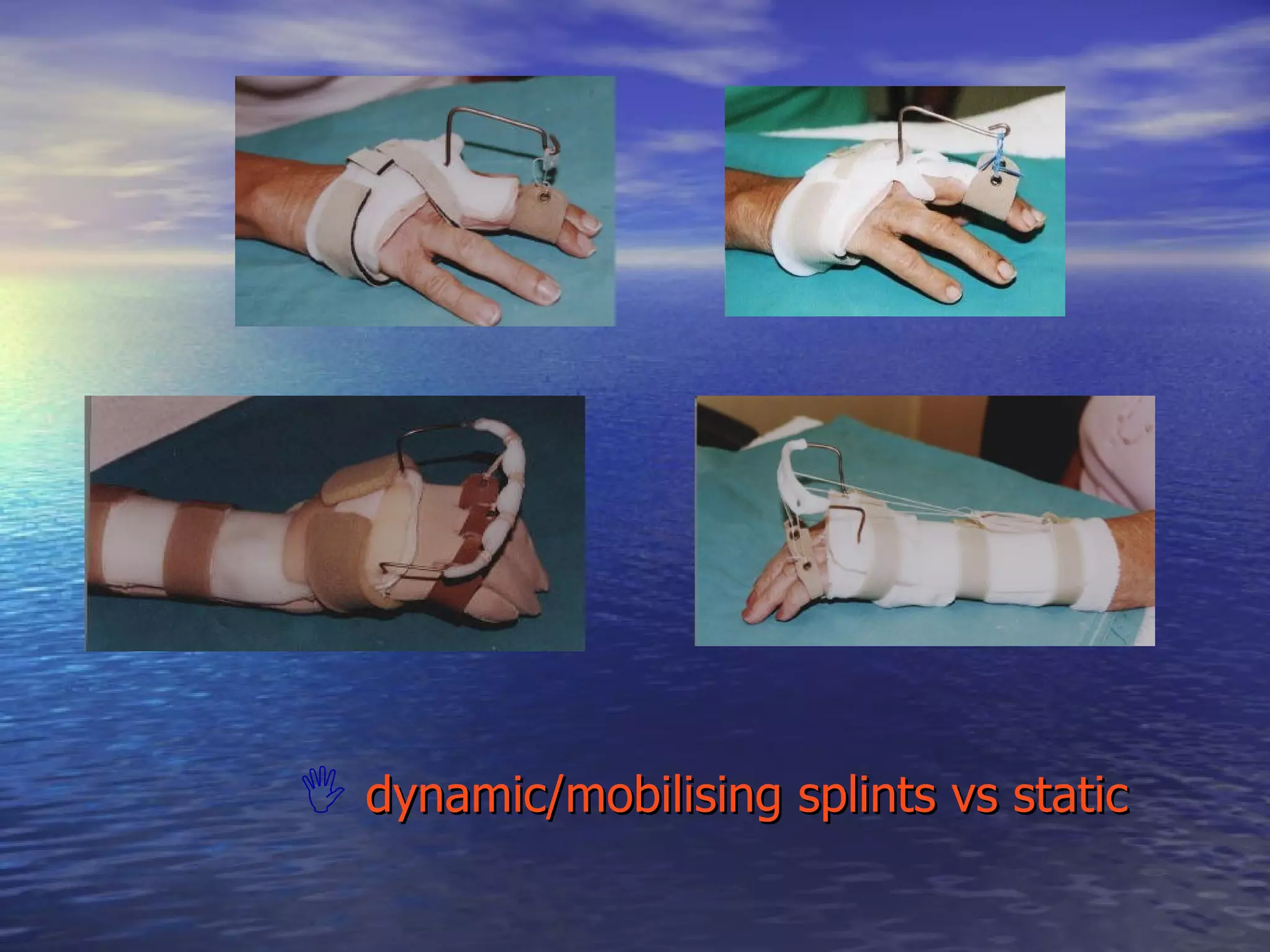 Hand Therapy Rehabilitation – Extensor Tendons | PPT