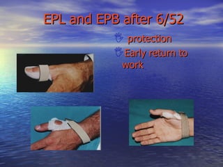 Hand Therapy Rehabilitation – Extensor Tendons | PPT