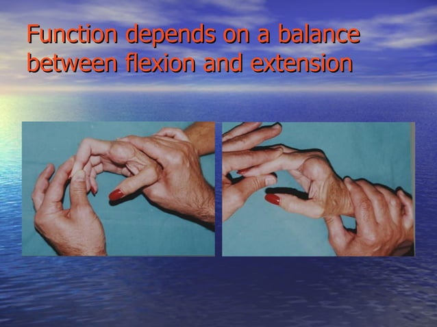 Hand Therapy Rehabilitation – Extensor Tendons | PPT | Free Download