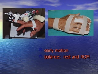 Hand Therapy Rehabilitation – Extensor Tendons | PPT