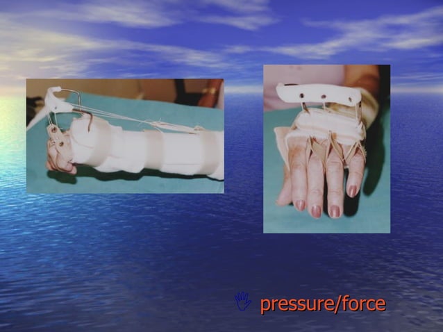 Hand Therapy Rehabilitation – Extensor Tendons | PPT