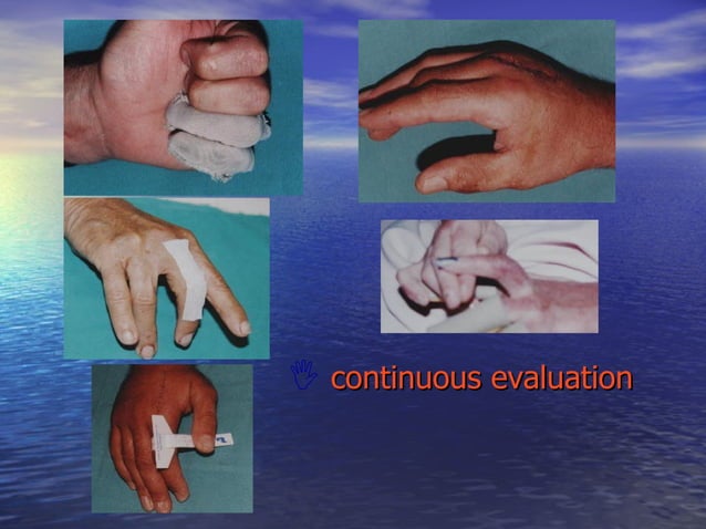 Hand Therapy Rehabilitation – Extensor Tendons | PPT