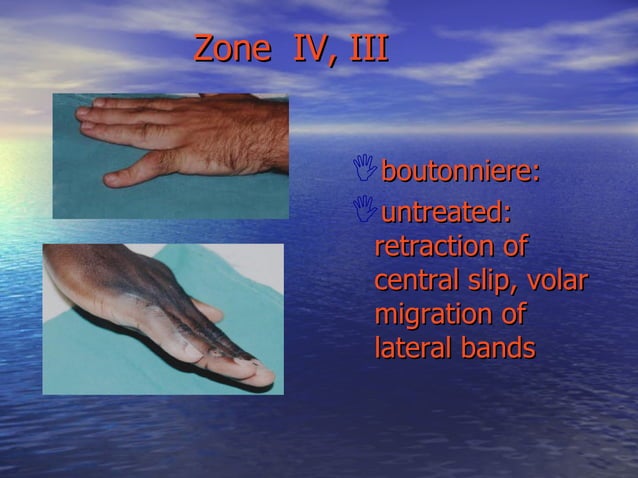 Hand Therapy Rehabilitation – Extensor Tendons | PPT
