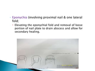 Eponychia
