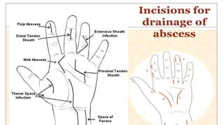 A BRIEF PRESENTION ON HAND AND HAND INFECTIONS | PPTX