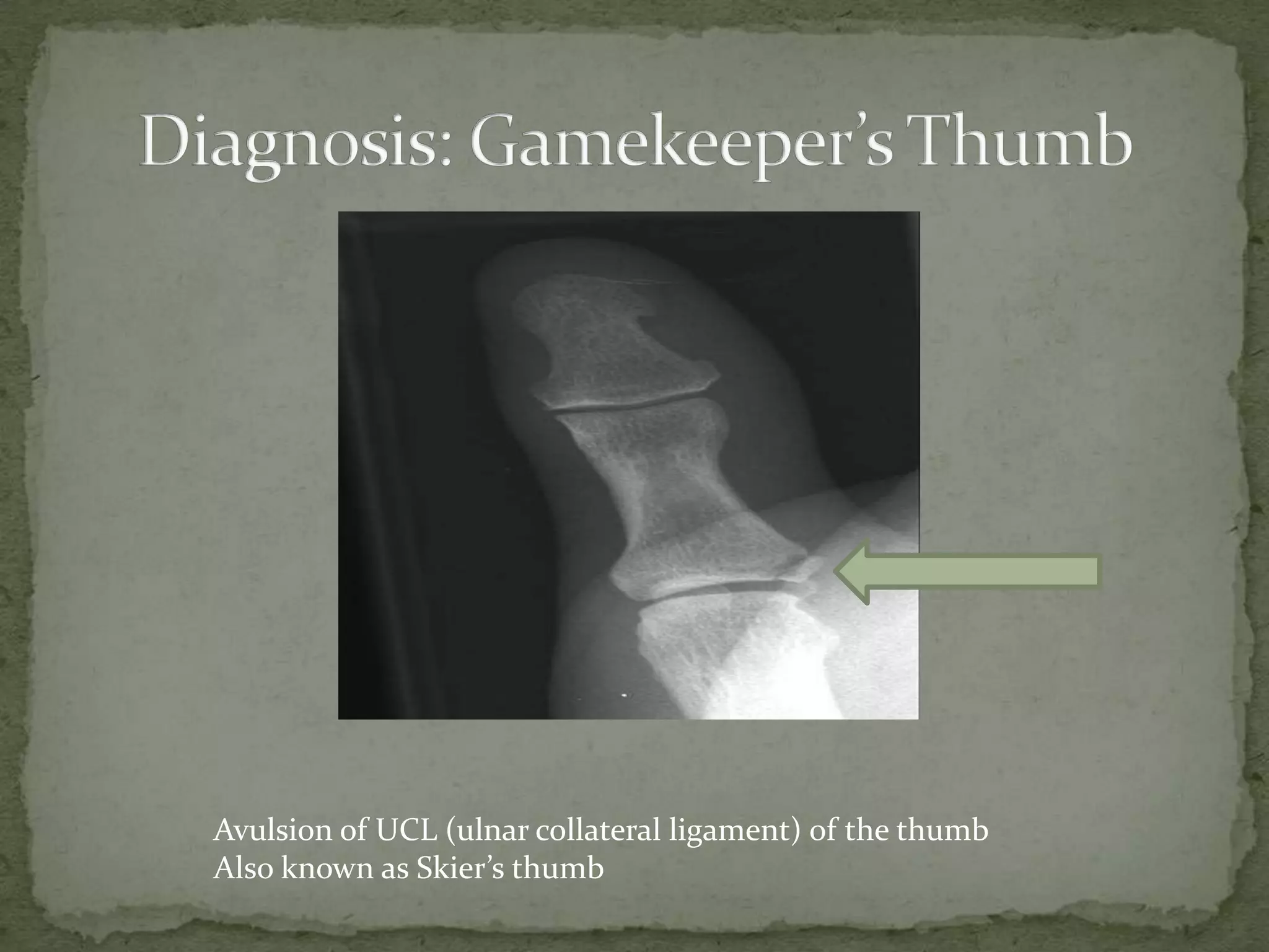Gamekeeper's Thumb | PPTX