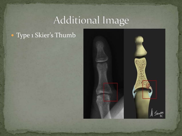 Gamekeeper's Thumb | PPTX | Death, Injury, or Military Conflict ...