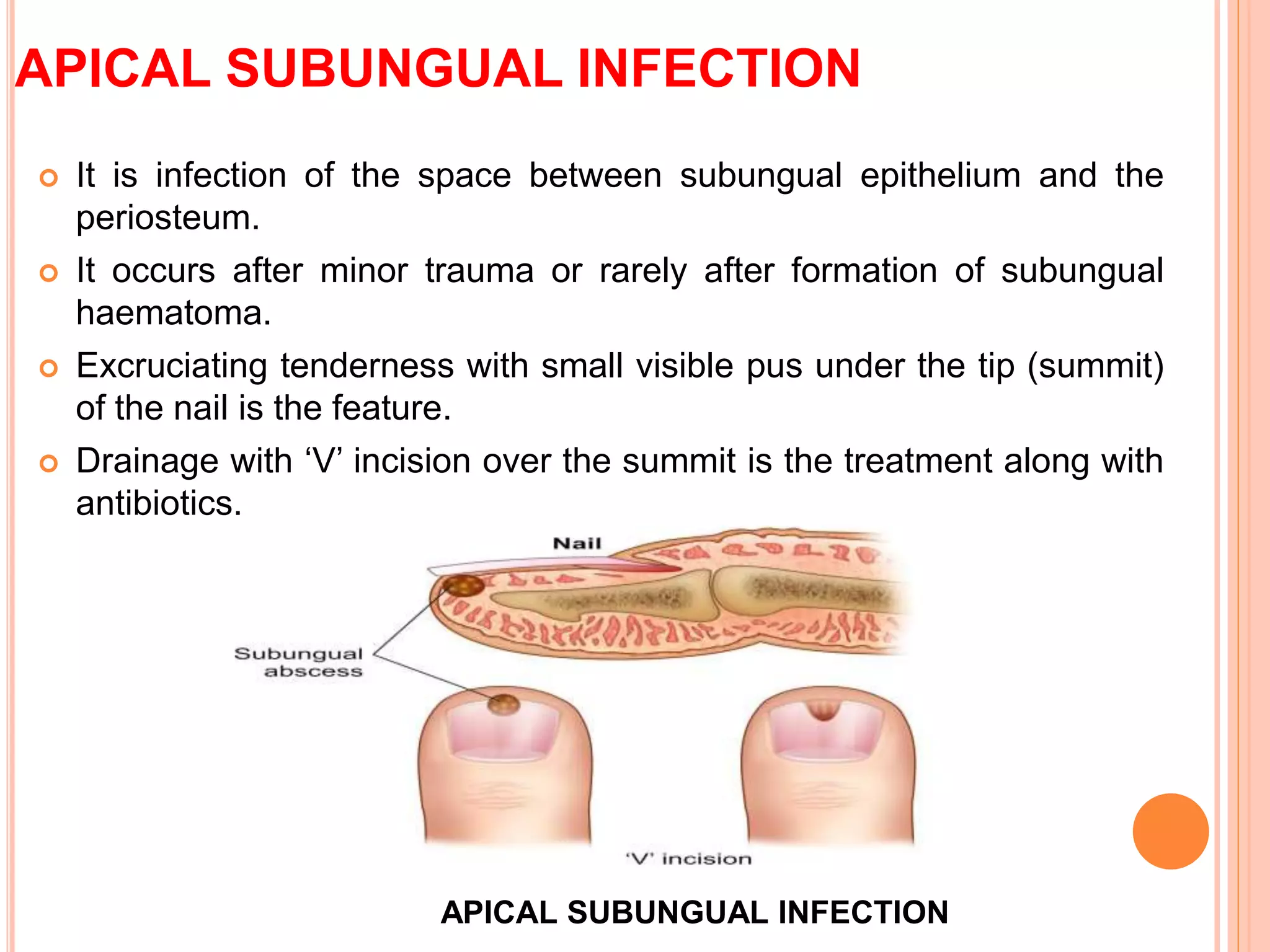 HAND ABSCESS SEMINAR.pptx