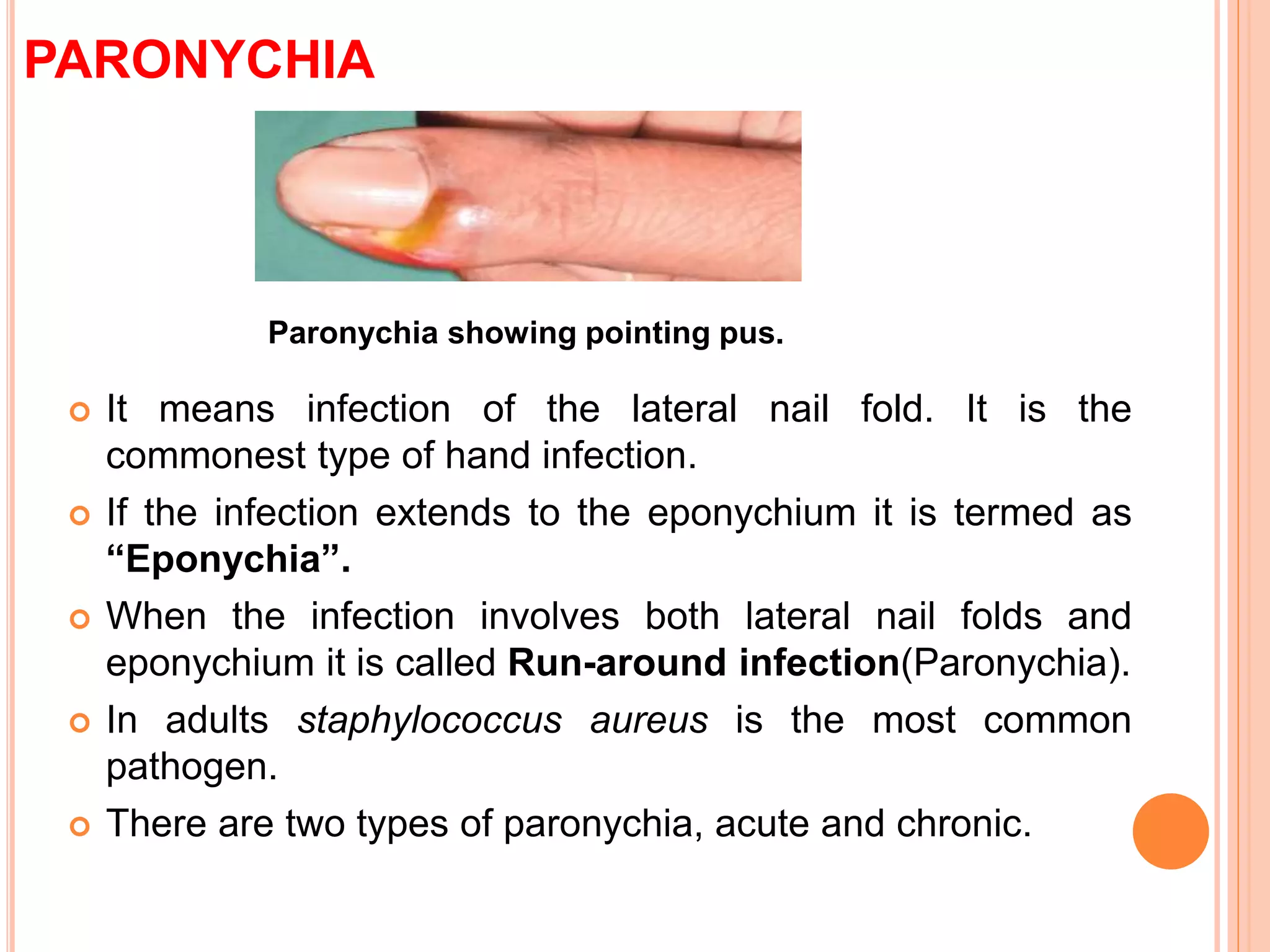 HAND ABSCESS SEMINAR.pptx