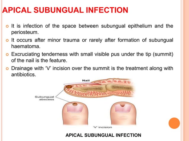HAND ABSCESS SEMINAR.pptx