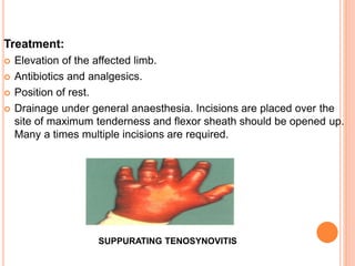 HAND ABSCESS SEMINAR.pptx