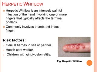HAND ABSCESS SEMINAR.pptx