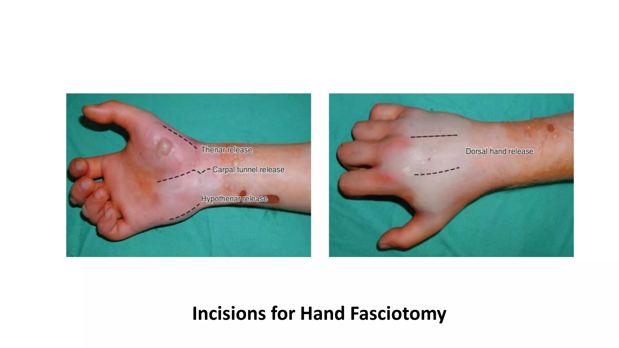 Hand anatomy 1 | PDF