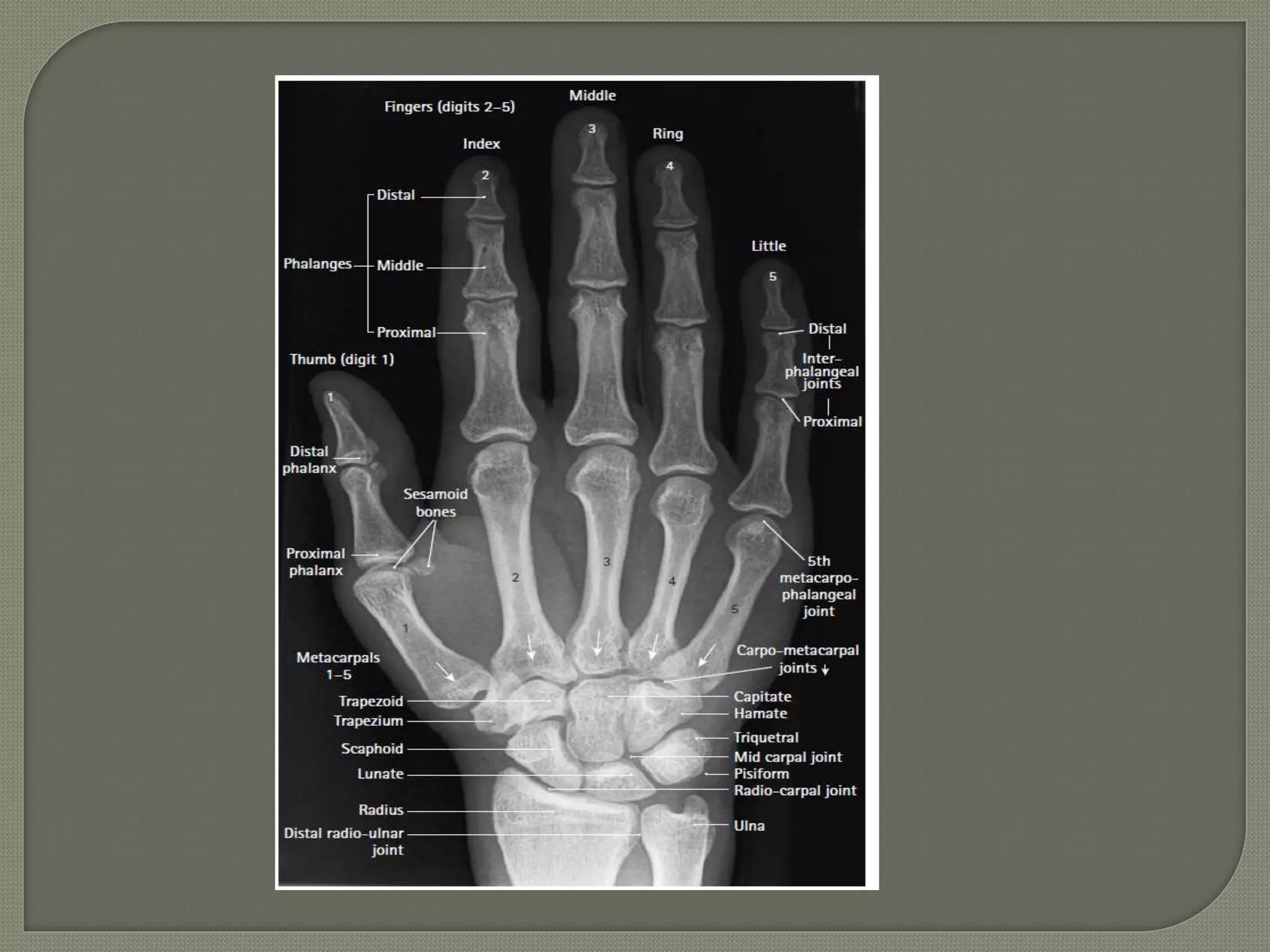 Hand and fore arm radiology truma girish gunar | PPTX