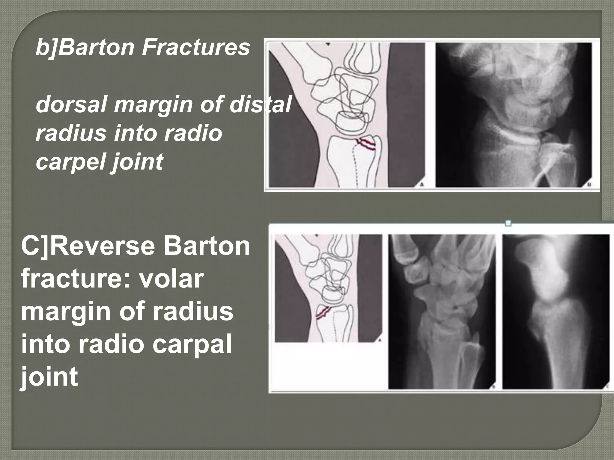 Hand and fore arm radiology truma girish gunar | PPTX