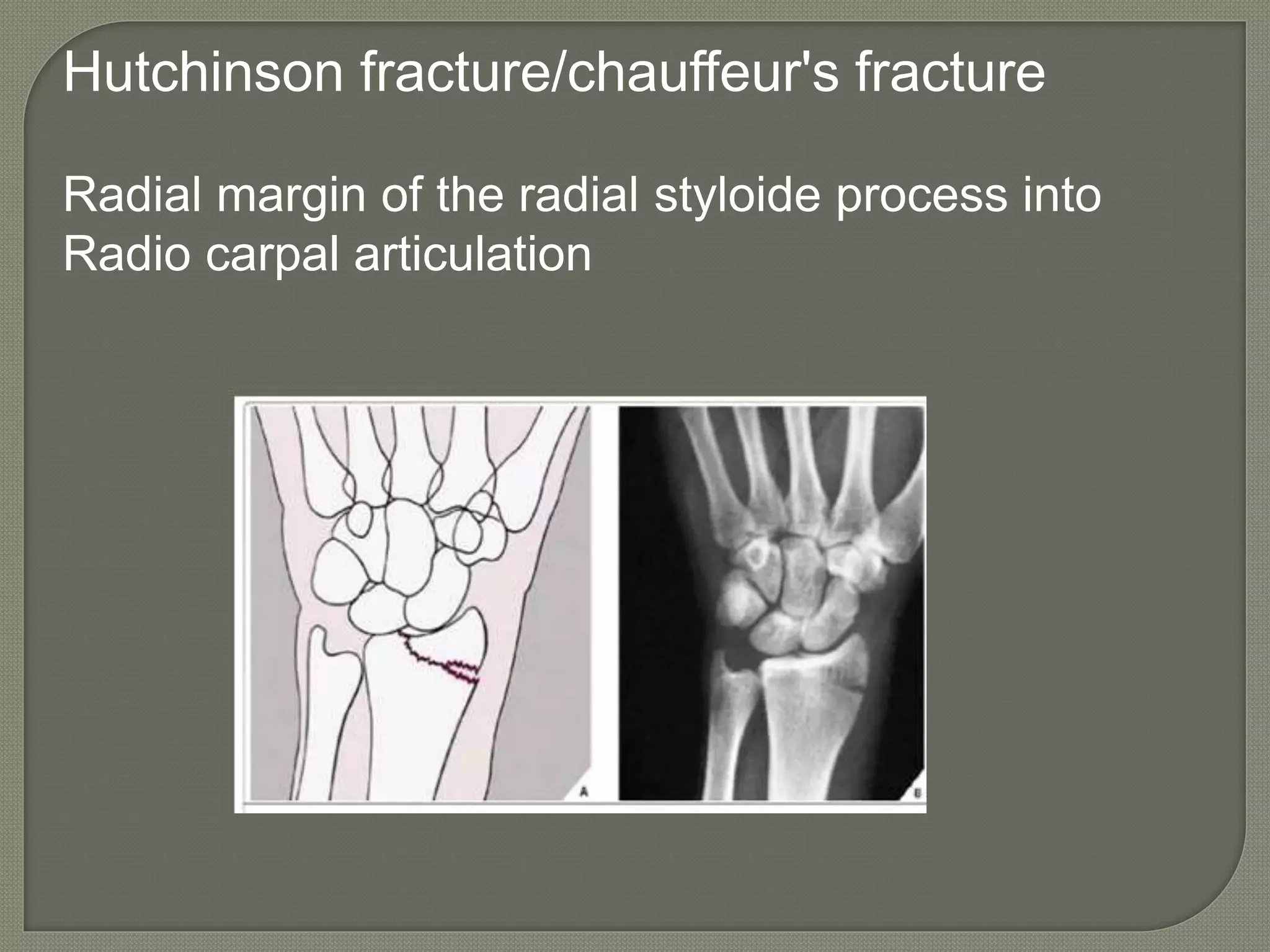 Hand and fore arm radiology truma girish gunar | PPTX