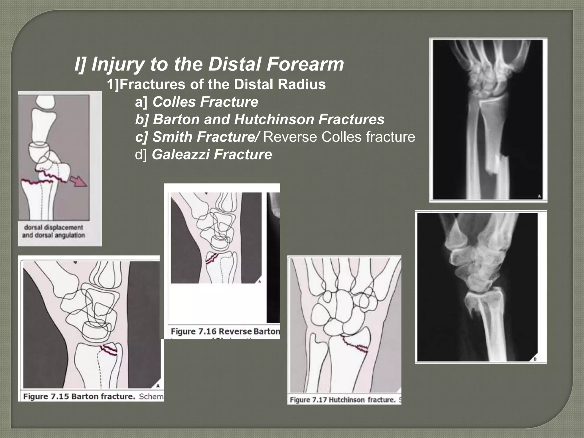 Hand and fore arm radiology truma girish gunar | PPTX