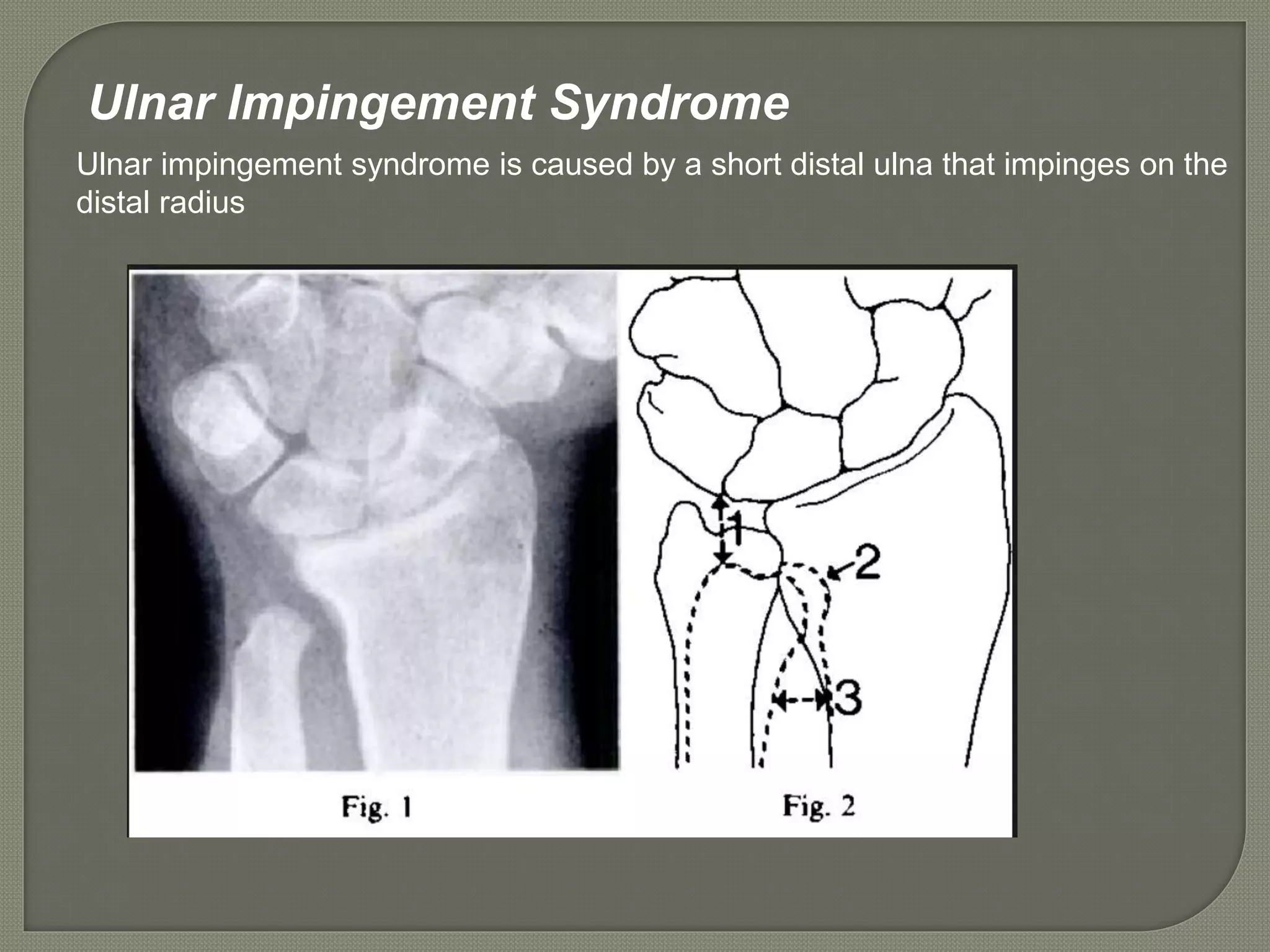Hand and fore arm radiology truma girish gunar | PPTX