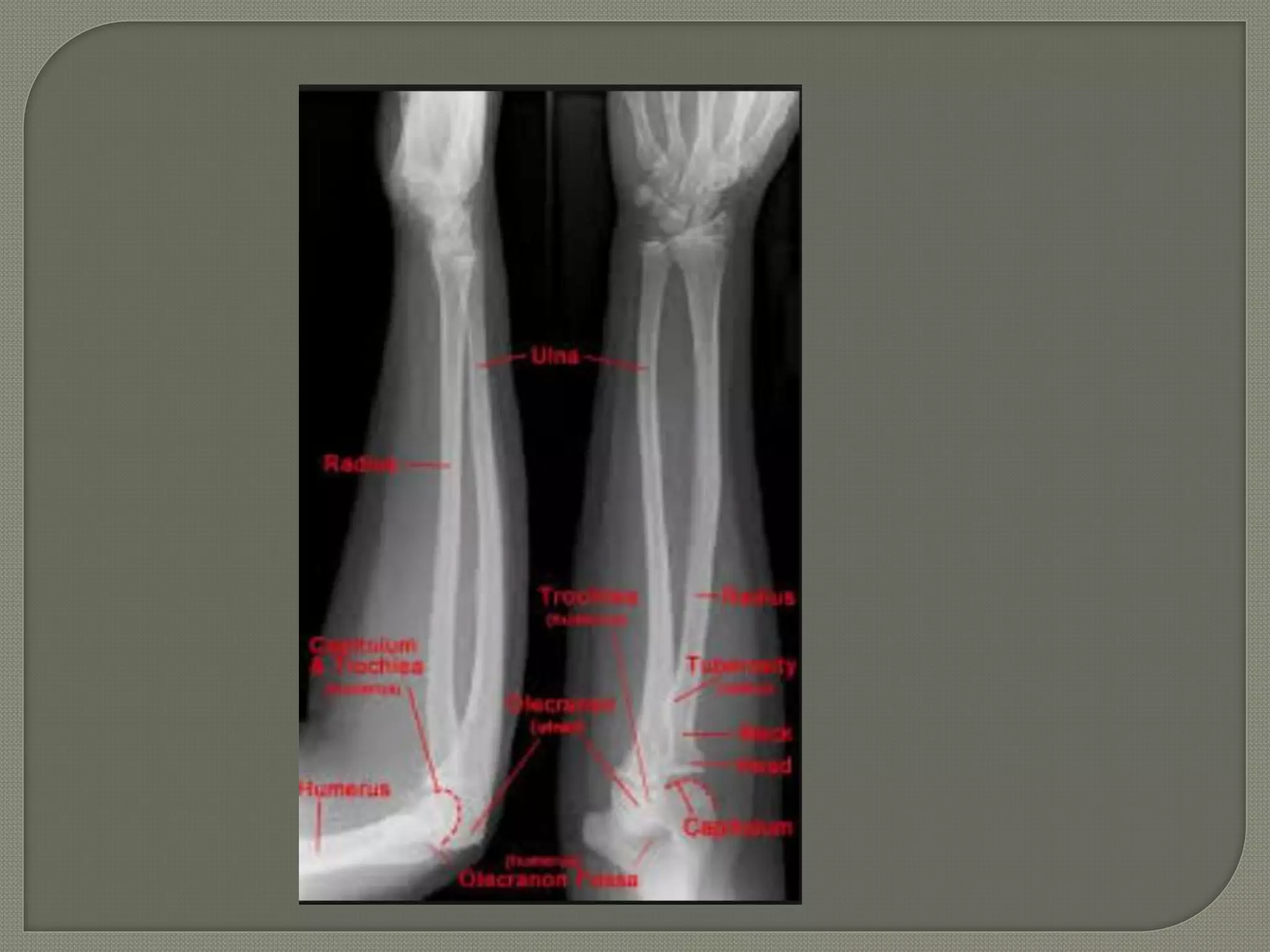 Hand and fore arm radiology truma girish gunar | PPT