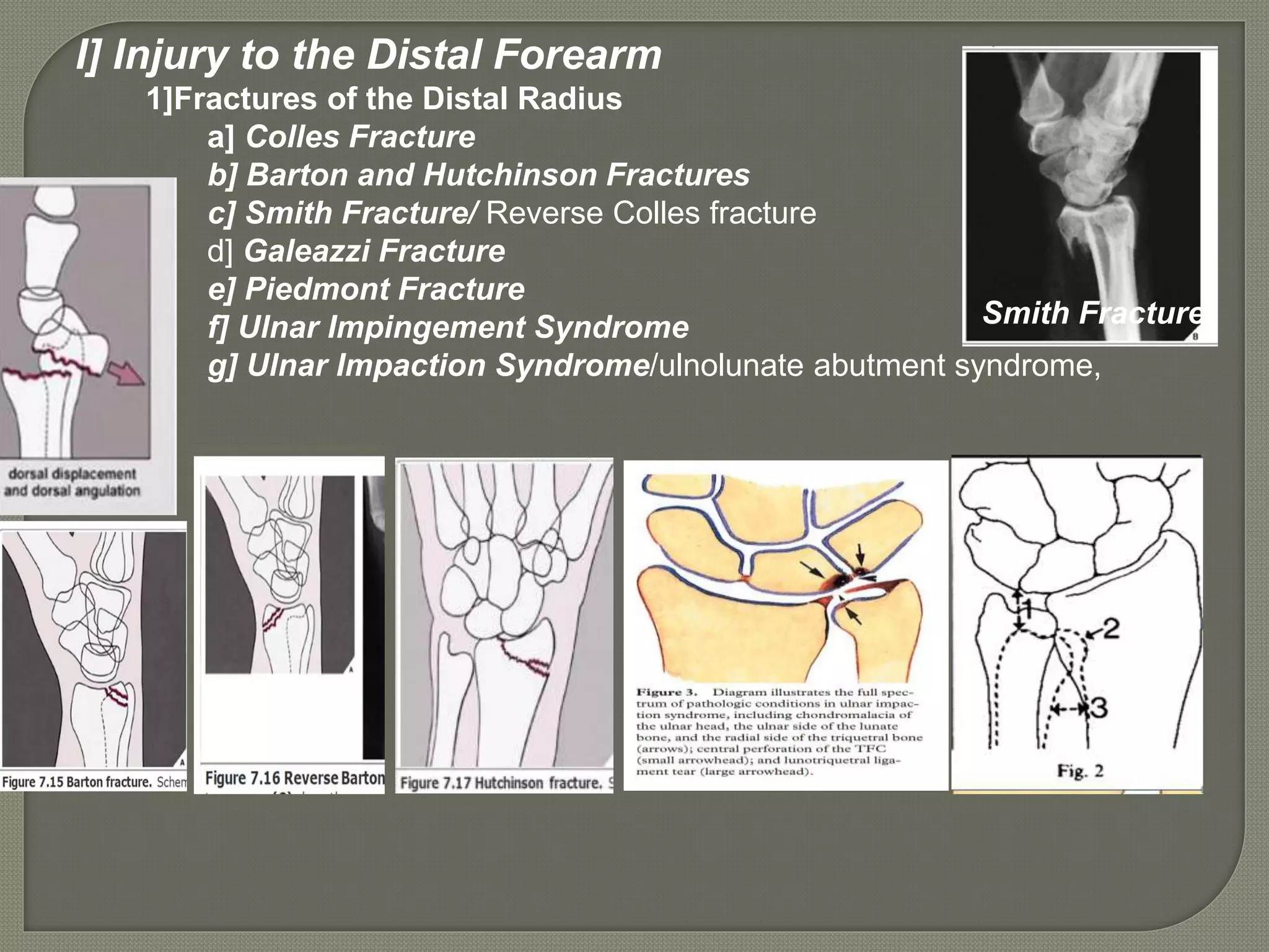 Hand and fore arm radiology truma girish gunar | PPTX