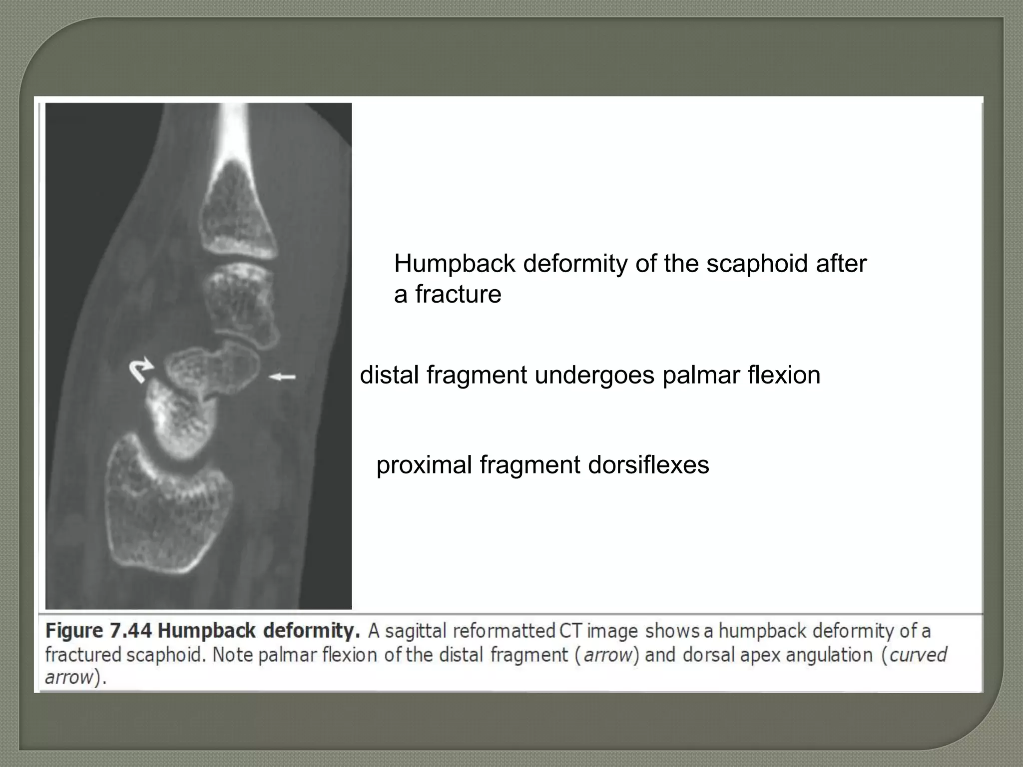 Hand and fore arm radiology truma girish gunar | PPTX