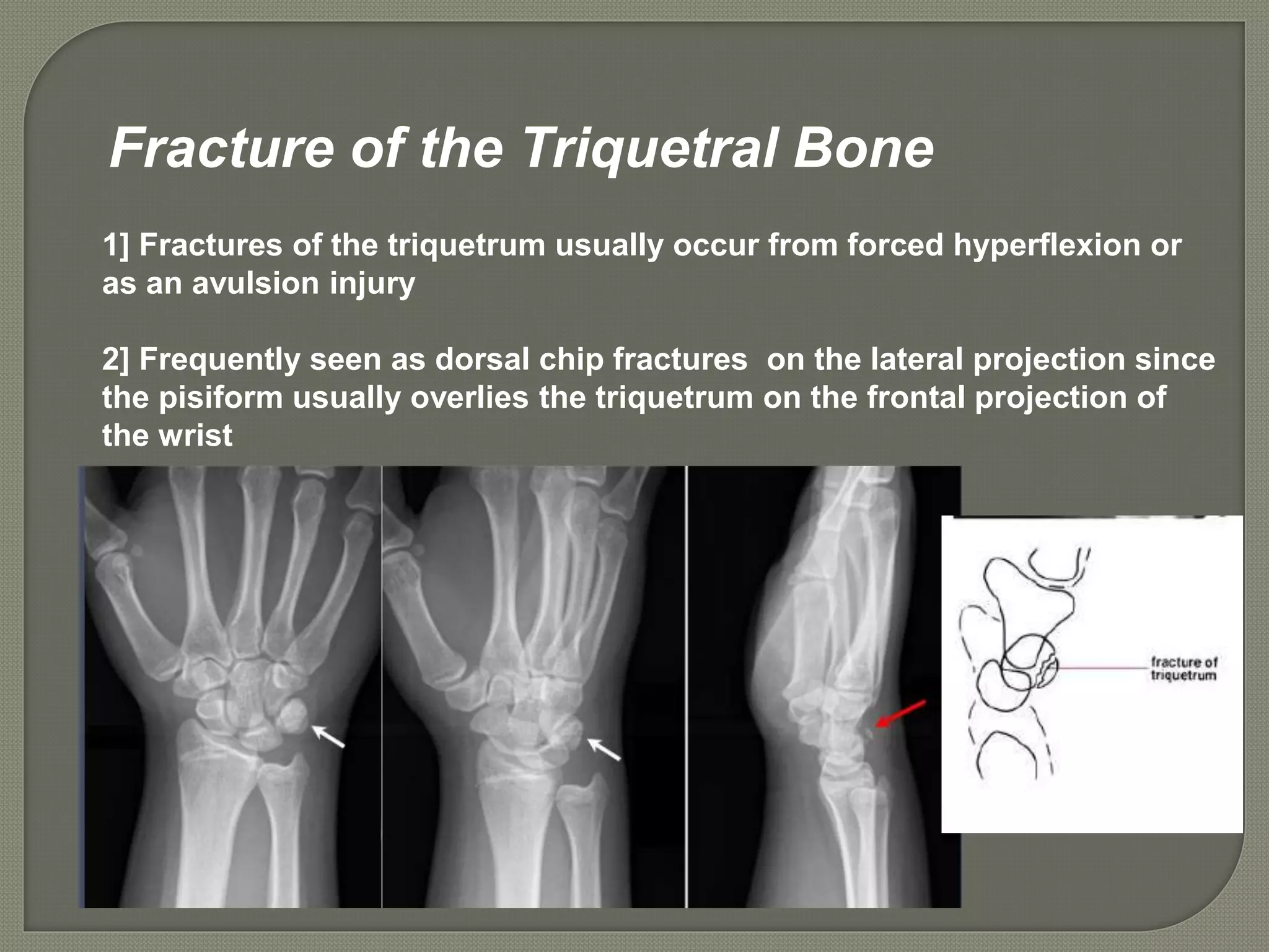 Hand and fore arm radiology truma girish gunar | PPTX