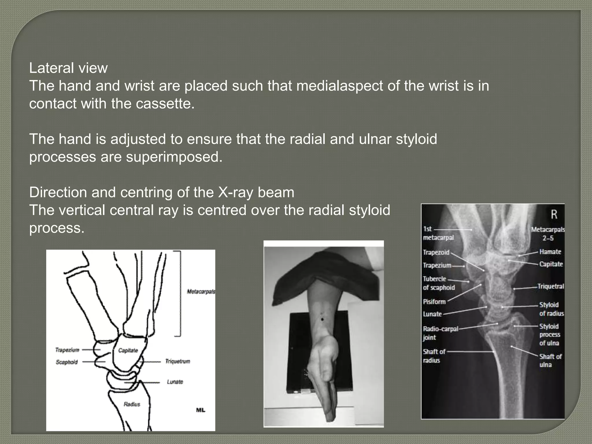 Hand and fore arm radiology truma girish gunar | PPTX