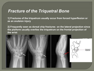 Hand and fore arm radiology truma girish gunar | PPTX