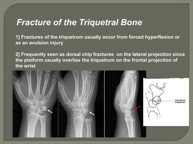 Hand and fore arm radiology truma girish gunar | PPT