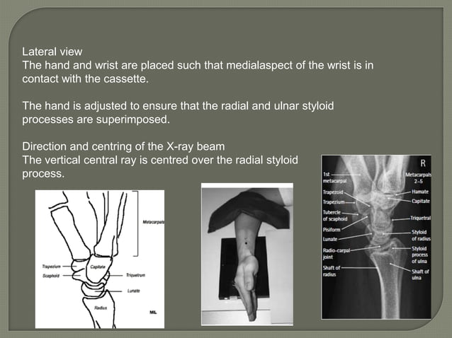 Hand and fore arm radiology truma girish gunar | PPT