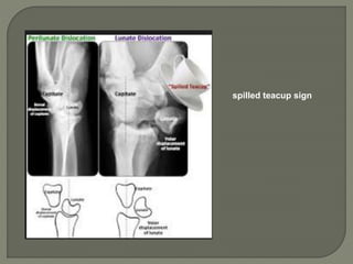 Hand and fore arm radiology truma girish gunar | PPTX