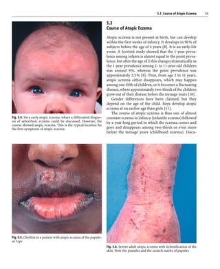 Handbook of Atopic Eczema. 2006.pdf