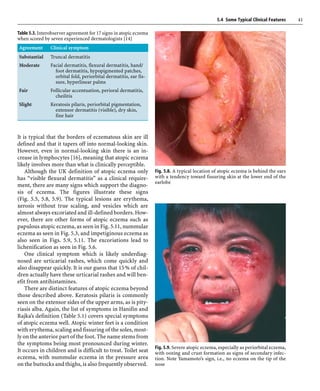 Handbook of Atopic Eczema. 2006.pdf