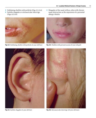 Handbook of Atopic Eczema. 2006.pdf