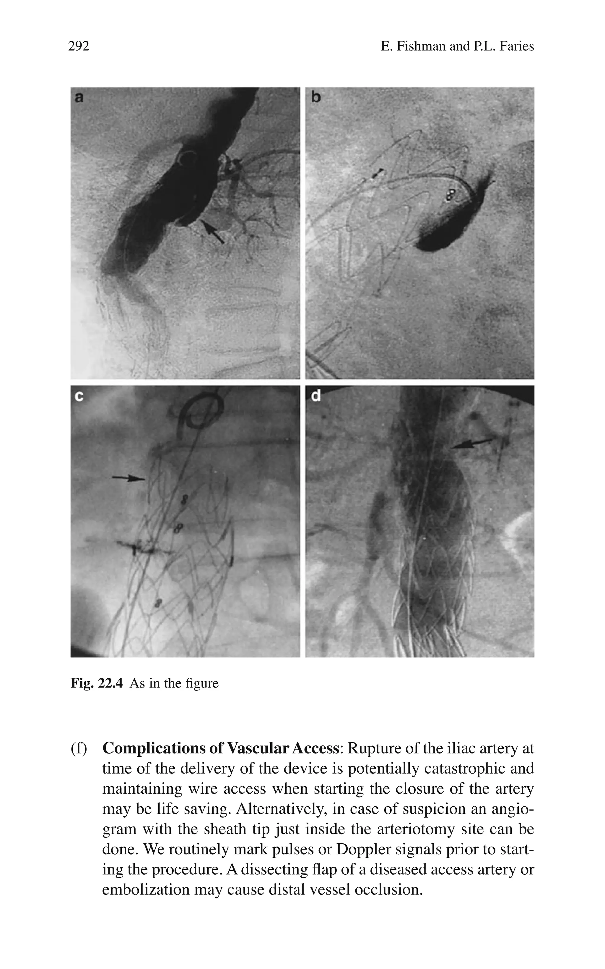 Handbook of Endovascular Interventions | PDF