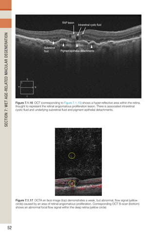 Handbook of Retinal OCT Second Edition.. | PDF
