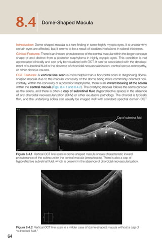 Handbook of Retinal OCT Second Edition.. | PDF