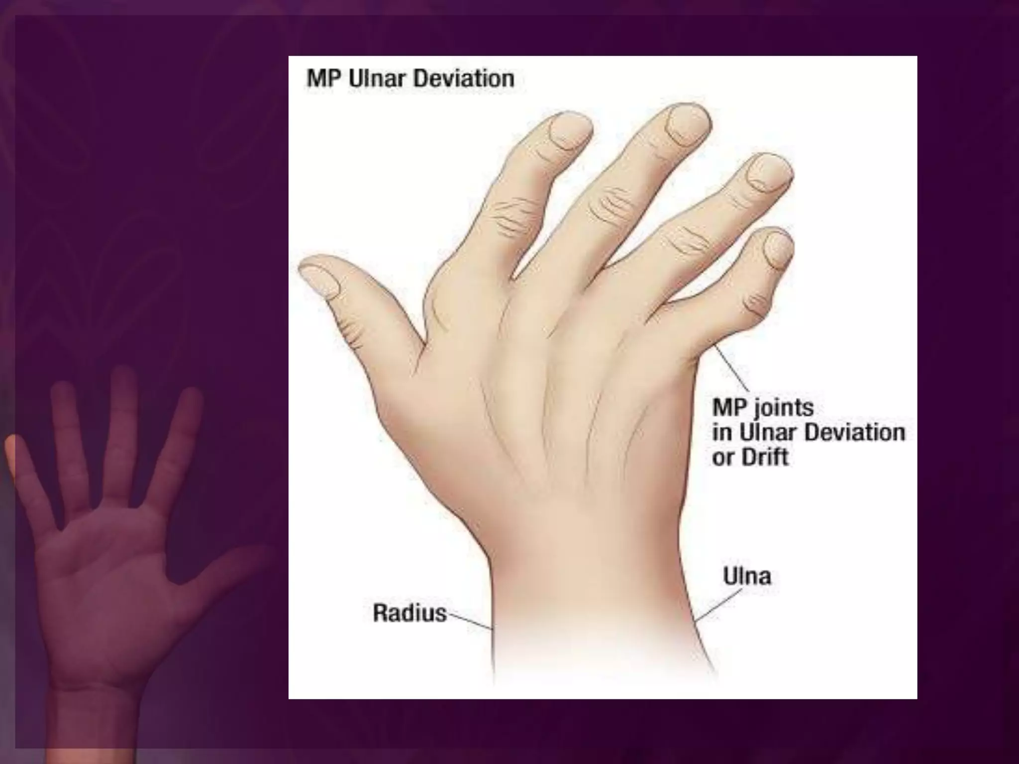 Hand deformities | PPTX