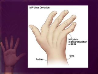 Hand deformities | PPTX