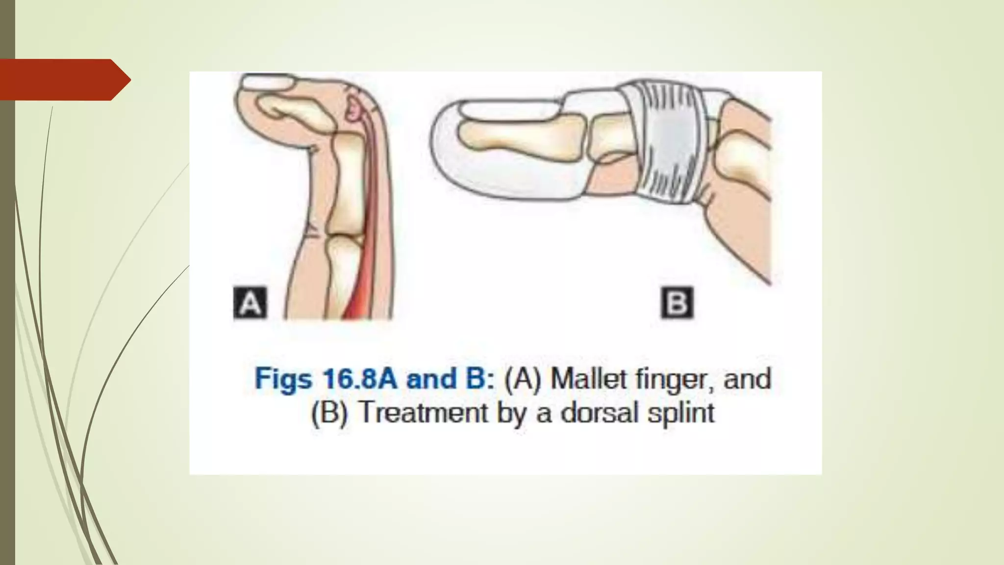 Hand deformities | PPTX